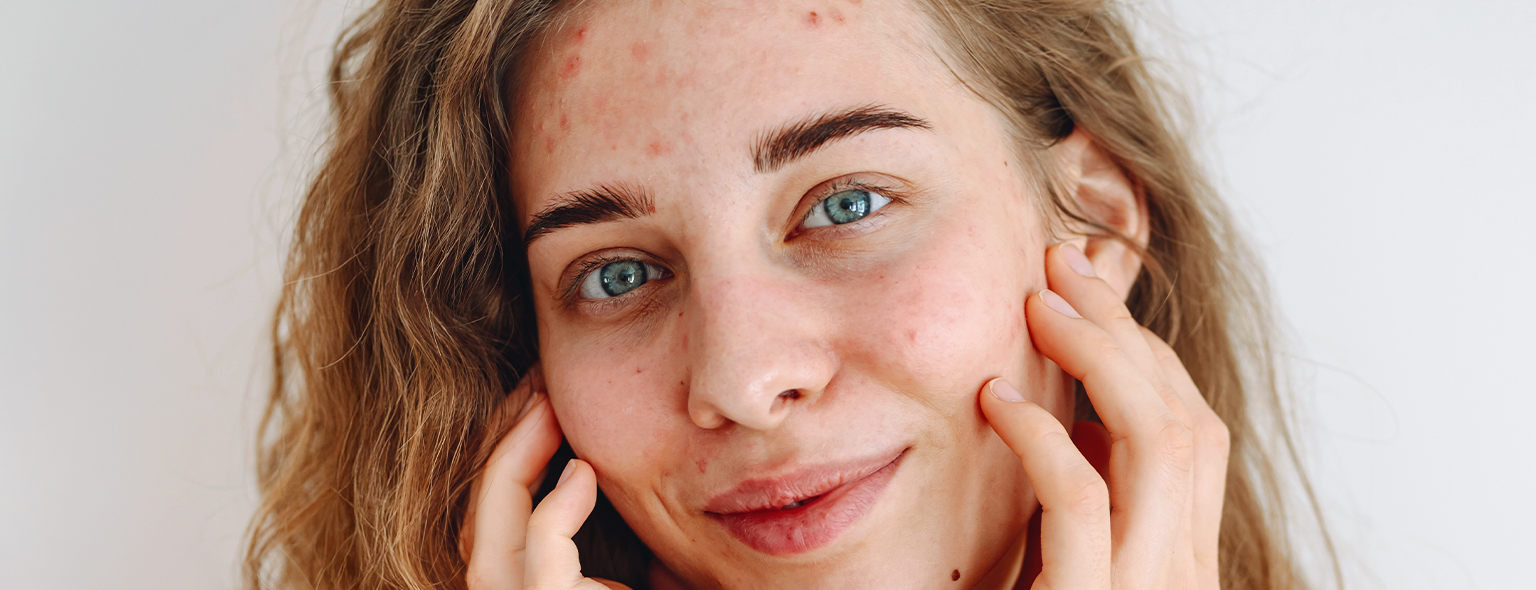 Puistjes: wat zijn het en wat doe je ertegen?