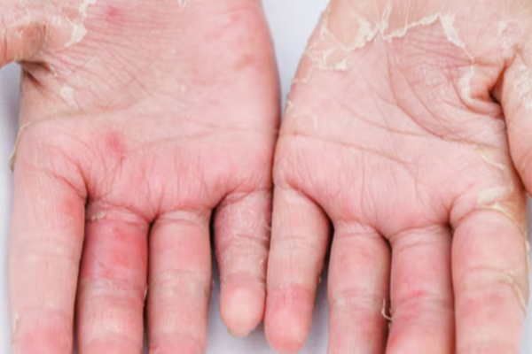 What Does Hay Fever Rash Look Like? | Holland & Barrett