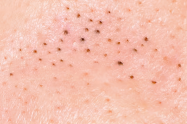 How To Get Rid Of Acne & Spots On Your Legs | Holland & Barrett