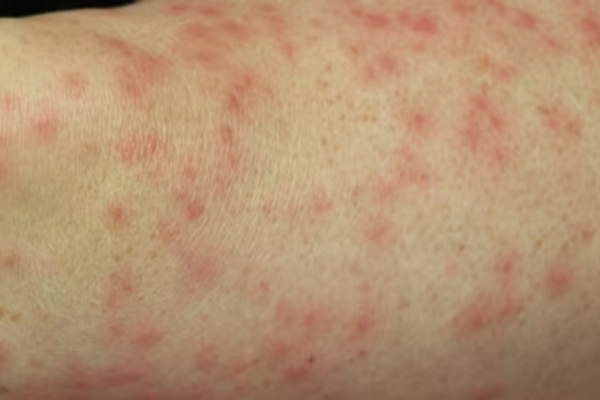 How To Get Rid Of Acne & Spots On Your Legs | Holland & Barrett