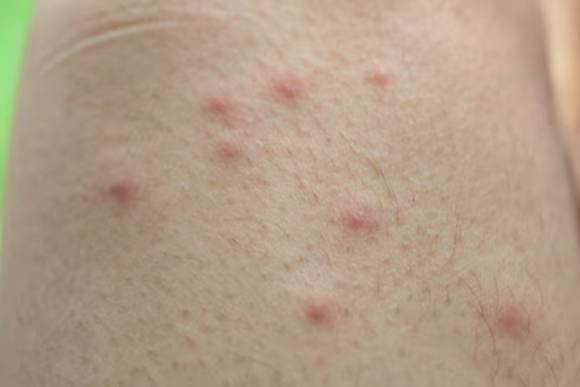 How To Get Rid Of Acne & Spots On Your Legs | Holland & Barrett