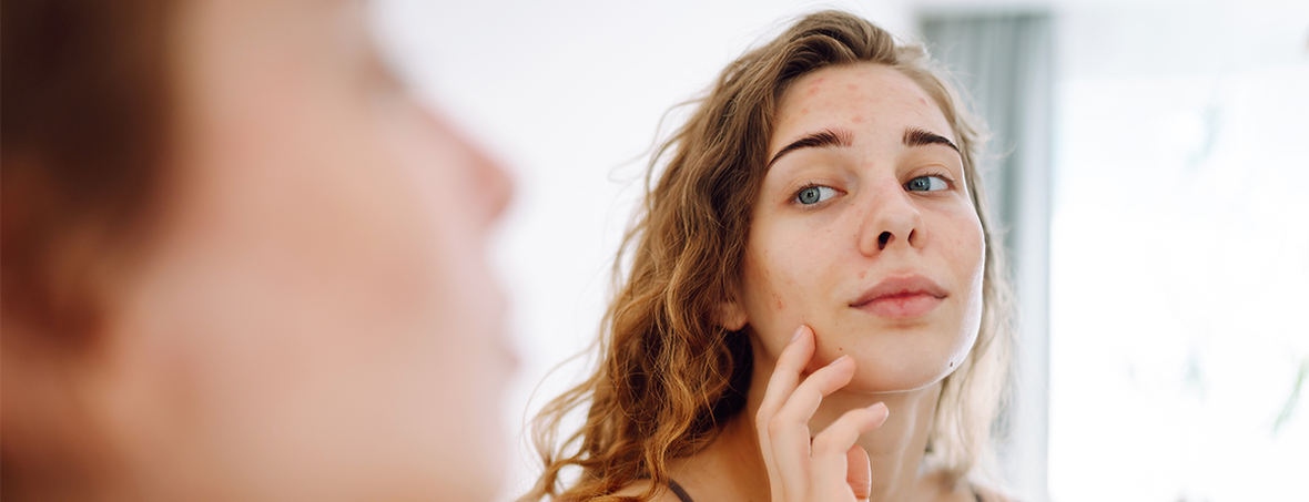 9 Ways To Manage Clogged Pores & Congested Skin | Holland & Barrett