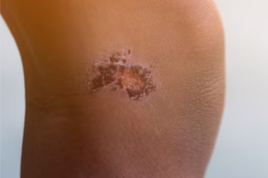 How To Get Rid Of Acne & Spots On Your Legs | Holland & Barrett