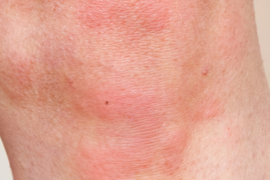 How To Get Rid Of Acne & Spots On Your Legs | Holland & Barrett