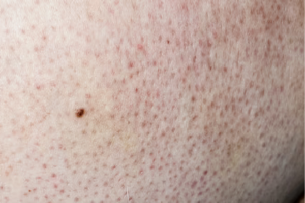 How To Get Rid Of Acne & Spots On Your Legs | Holland & Barrett