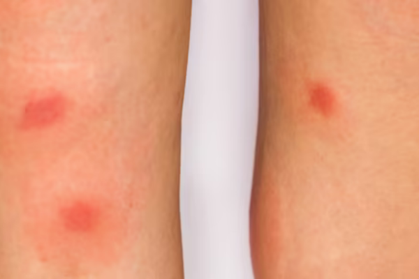 How To Get Rid Of Acne & Spots On Your Legs | Holland & Barrett