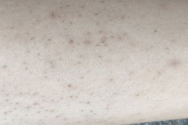 How To Get Rid Of Acne & Spots On Your Legs | Holland & Barrett