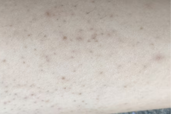 How To Get Rid Of Acne & Spots On Your Legs | Holland & Barrett